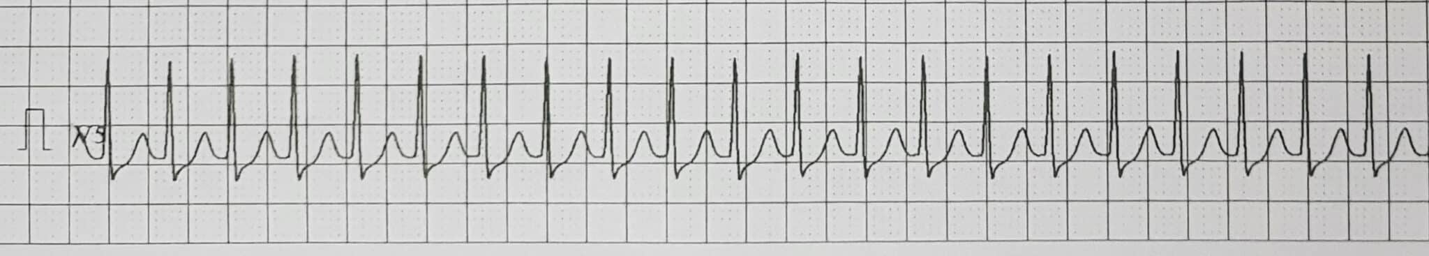 Rhythms Originating from the Atrium | 12-Lead ECG Resources | ACLS ...