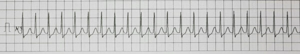 Rhythms Originating from the Atrium | 12-Lead ECG Resources | ACLS ...