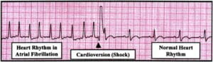 Tachycardia with a Pulse Algorithm Explained | ACLS Resources | ACLS ...