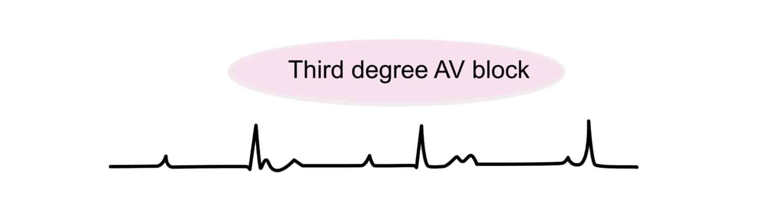 The Bradyarrhythmias | Arrhythmia Interpretation Resources | ACLS ...
