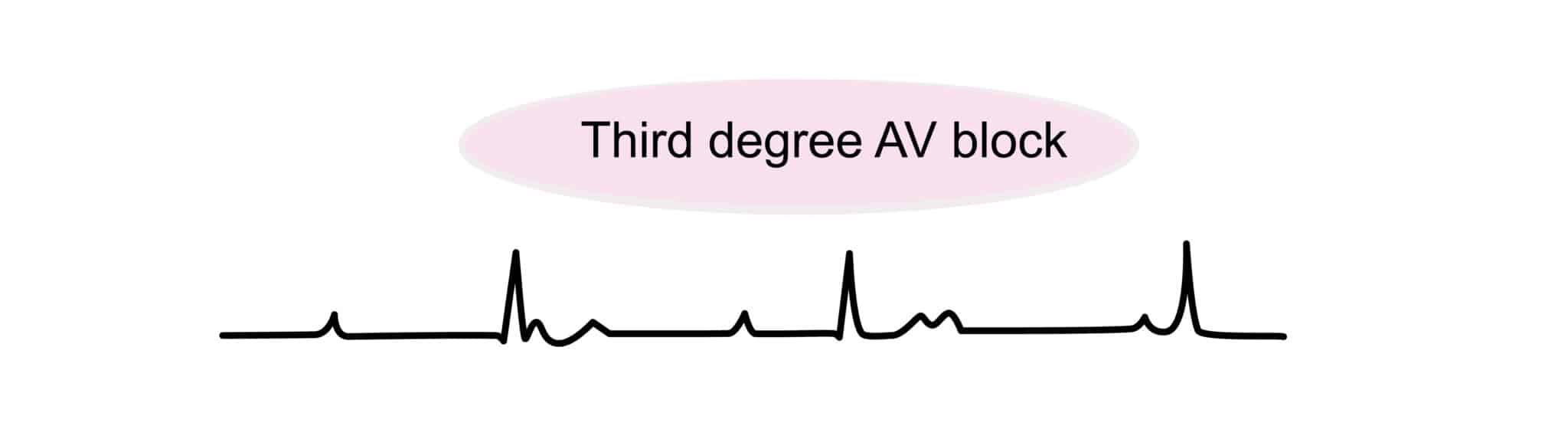 The Bradyarrhythmias | Arrhythmia Interpretation Resources | ACLS ...