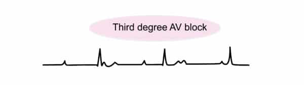Bradyarrhythmias: ACLS Identification & Treatment Guide