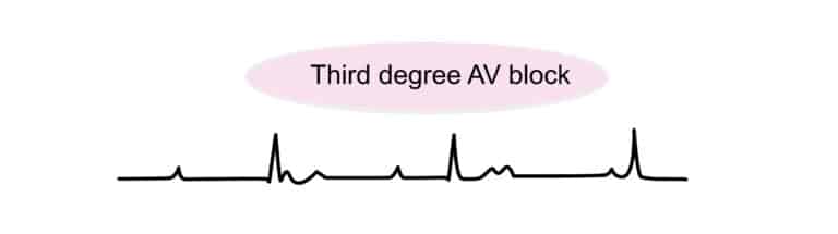 The Bradyarrhythmias | Arrhythmia Interpretation Resources | ACLS ...