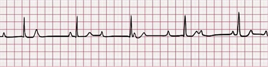 Atrioventricular Block or AV Block | 12-Lead ECG Resources | ACLS ...