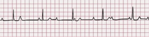 Atrioventricular Block or AV Block | 12-Lead ECG Resources | ACLS ...