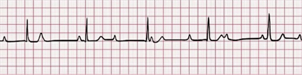 Atrioventricular Block or AV Block | 12-Lead ECG Resources | ACLS ...