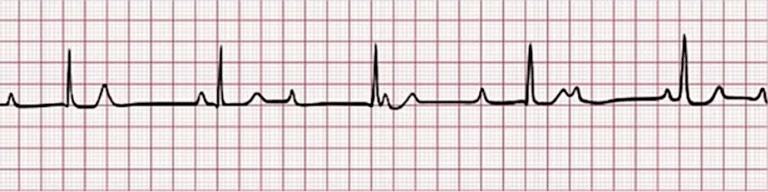 Atrioventricular Blocks (AV Blocks) Explained