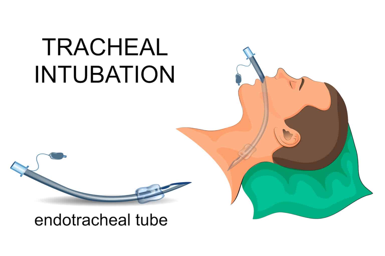 Endotracheal Intubation | ACLS Ressources | ACLS Certification Association