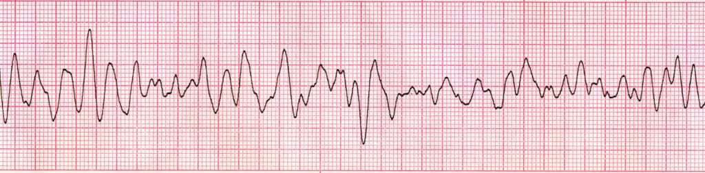 Ventricular Rhythms and Asystole | Arrhythmia Interpretation Resources ...