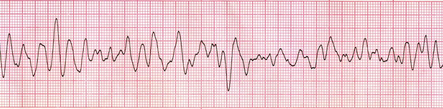 Ventricular Rhythms and Asystole | Arrhythmia Interpretation Resources ...