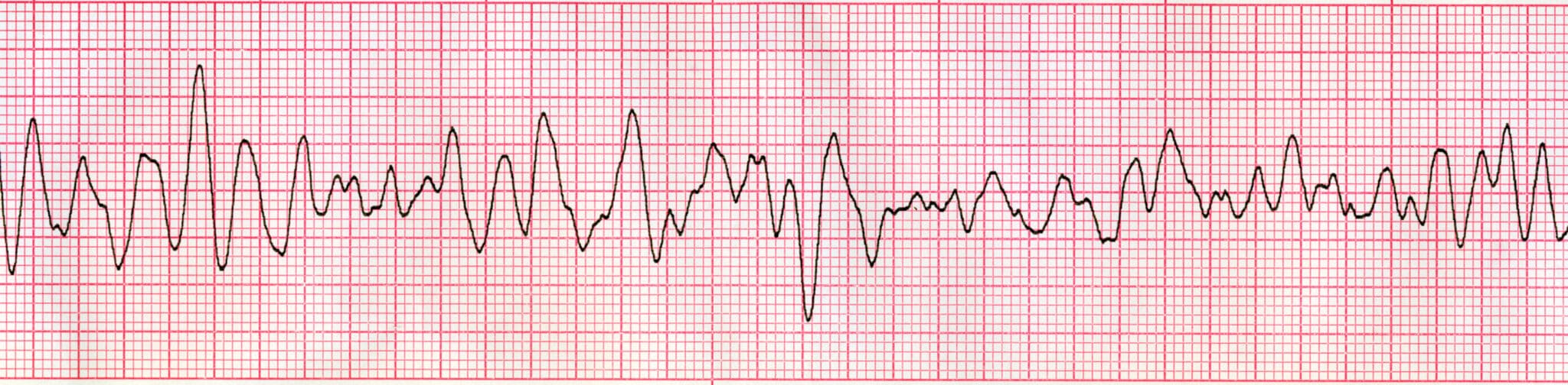 Ventricular Rhythms and Asystole | Arrhythmia Interpretation Resources ...