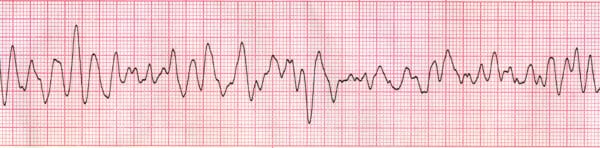 VF and PVT | Care of the Patient with a Shockable Rhythm | ACLS ...