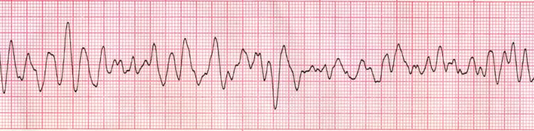 Rhythm-based Management in Cardiac Arrest | ACLS Resources | ACLS ...