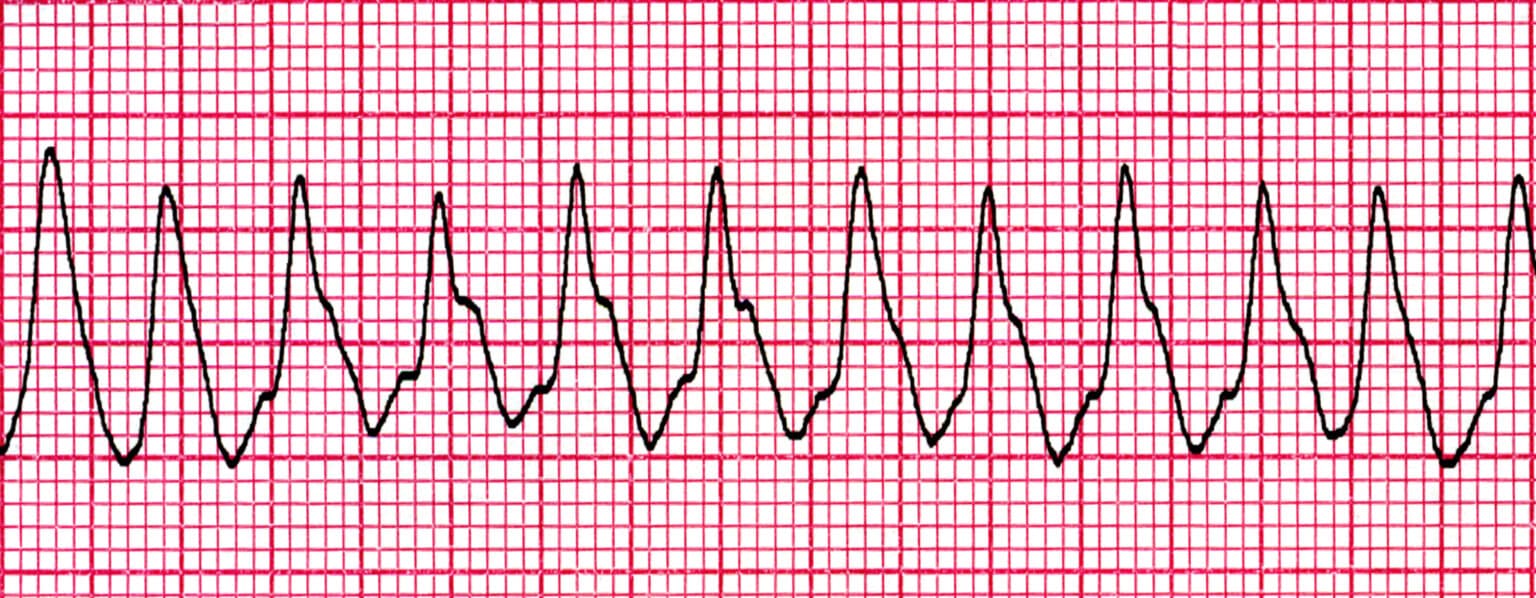 Ventricular Rhythms and Asystole | Arrhythmia Interpretation Resources ...