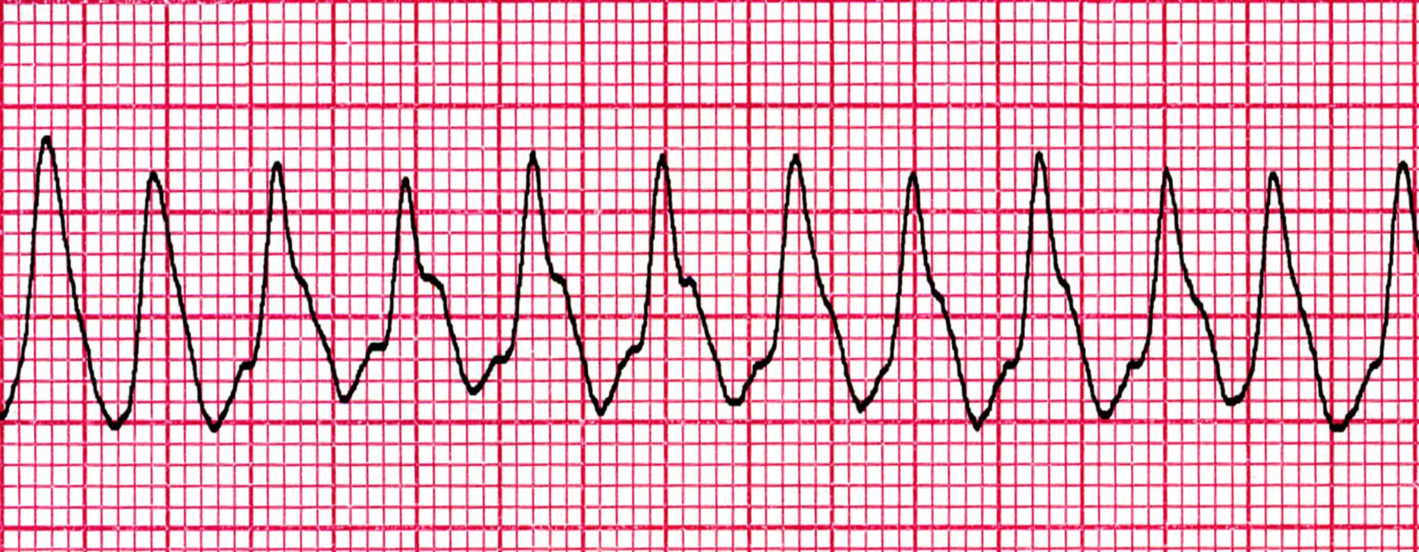 Interpreting an ECG Strip | 12-Lead ECG Resources | ACLS Certification ...