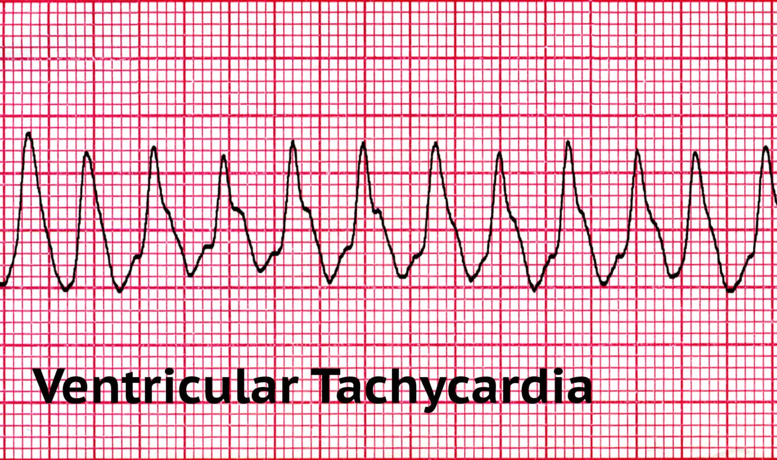 Tachycardia with a Pulse Algorithm Explained | ACLS Resources | ACLS ...