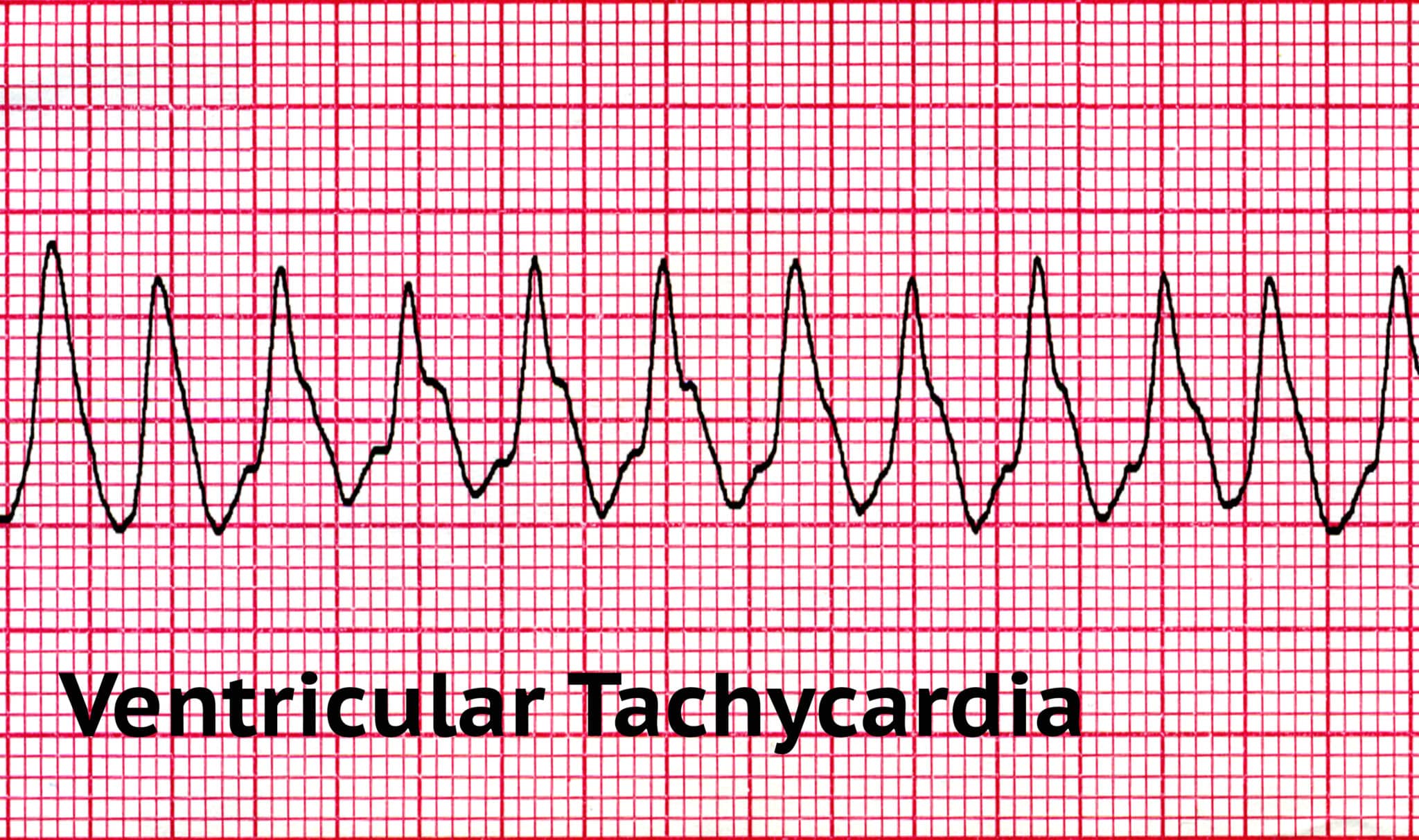 Tachycardia with a Pulse Algorithm Explained | ACLS Resources | ACLS ...
