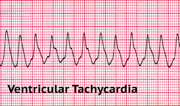 Tachycardia with a Pulse Algorithm Explained | ACLS Resources | ACLS ...