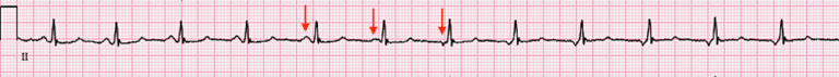 Rhythms Originating from the Atrium | 12-Lead ECG Resources | ACLS ...