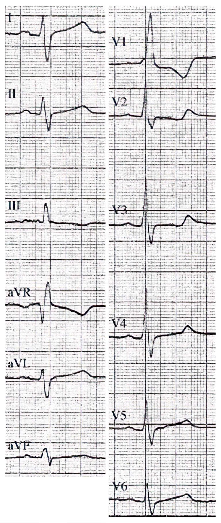 Topic - Right Ventricular Hypertrophy - Exercises | 12-Lead ECG ...