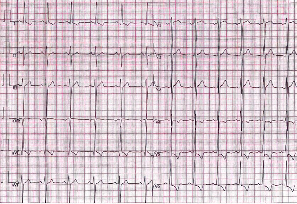 Topic - Electrocardiographic Criteria for Diagnosing Left Ventricular ...