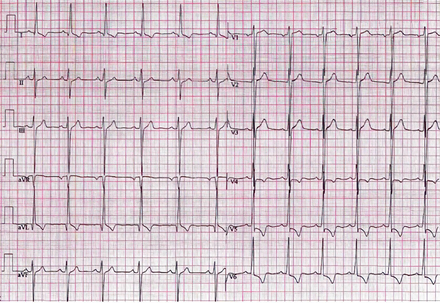 Topic - Electrocardiographic Criteria for Diagnosing Left Ventricular ...