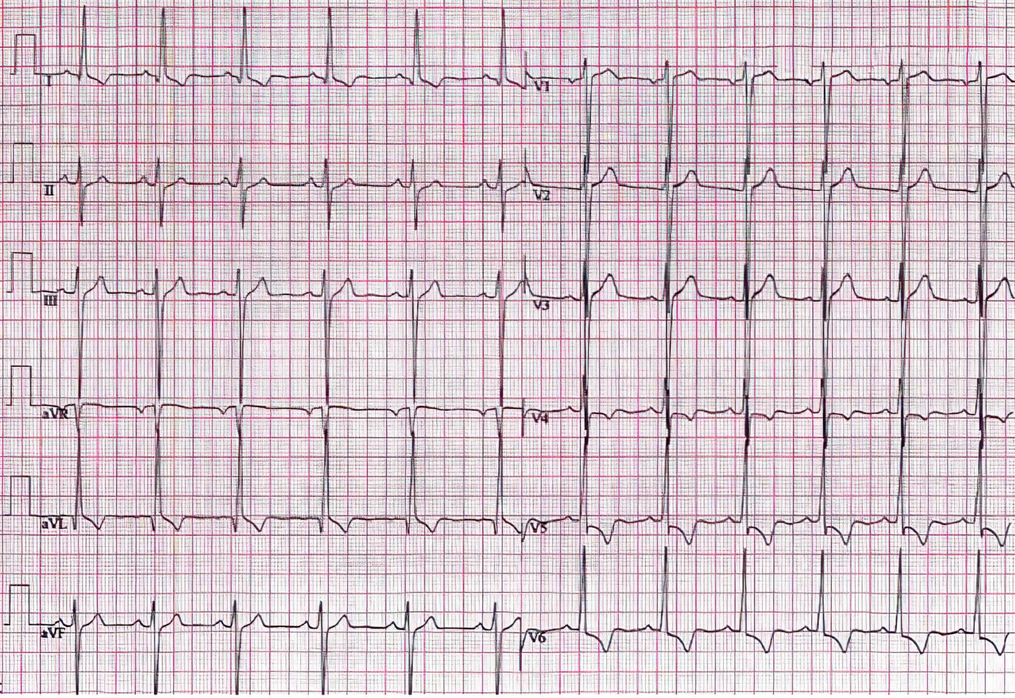 Topic - Electrocardiographic Criteria for Diagnosing Left Ventricular ...