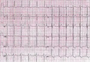 Topic - Electrocardiographic Criteria for Diagnosing Left Ventricular ...