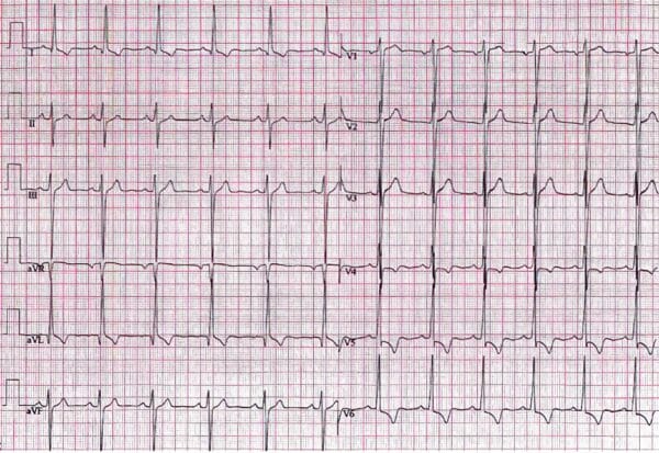 Topic - Electrocardiographic Criteria for Diagnosing Left Ventricular ...
