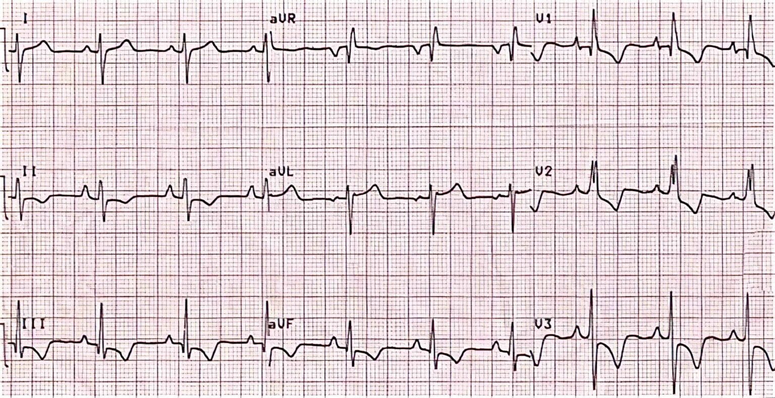 Topic - Electrocardiographic Findings | 12 Lead ECG Course | ACLS ...