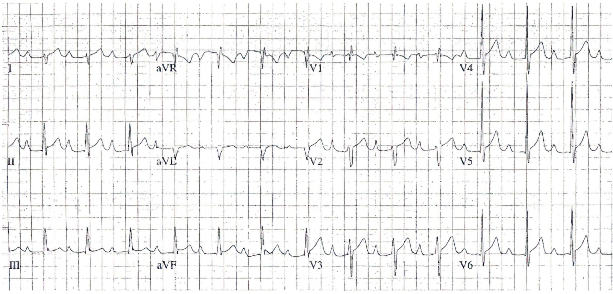 Topic - Biatrial Enlargement or P Biatriale | 12-Lead ECG Certification ...