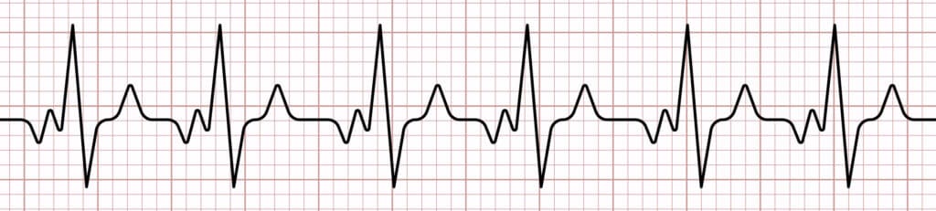 Topic - Checklist for Fibrinolytic Therapy | ACLS Course | ACLS ...