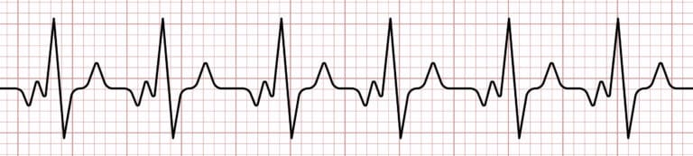 Topic - Checklist for Fibrinolytic Therapy | ACLS Course | ACLS ...