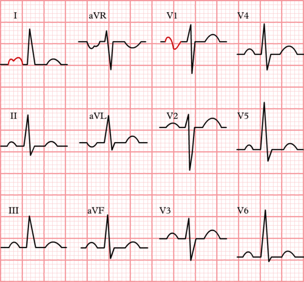 Topic - Left Atrial Enlargement / P Mitrale | 12-Lead ECG Certification ...