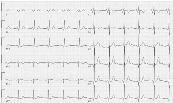 Topic - Left Atrial Enlargement / P Mitrale | 12-Lead ECG Certification ...