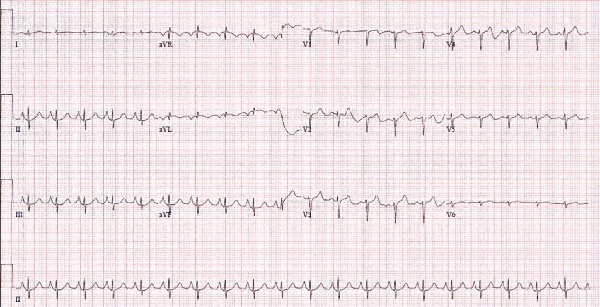 Topic - Right Atrial Enlargement or P Pulmonale | 12-Lead ECG ...