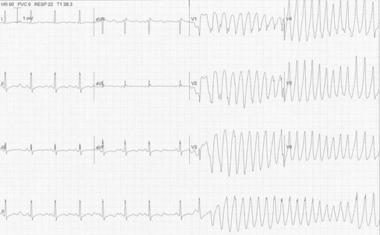 Ventricular Rhythms Quiz 1 | 12-Lead ECG Practice Test Online | ACLS ...