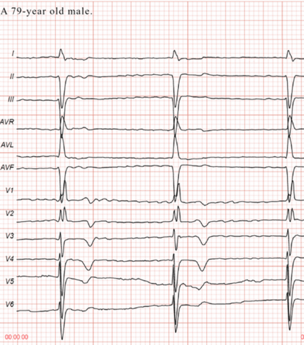 Cardiac Blocks Quiz | 12-Lead ECG Practice Test Online | ACLS ...