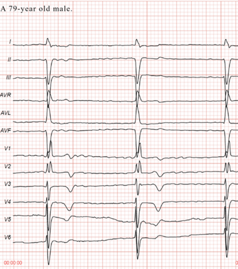 Cardiac Blocks Quiz | 12-Lead ECG Practice Test Online | ACLS ...
