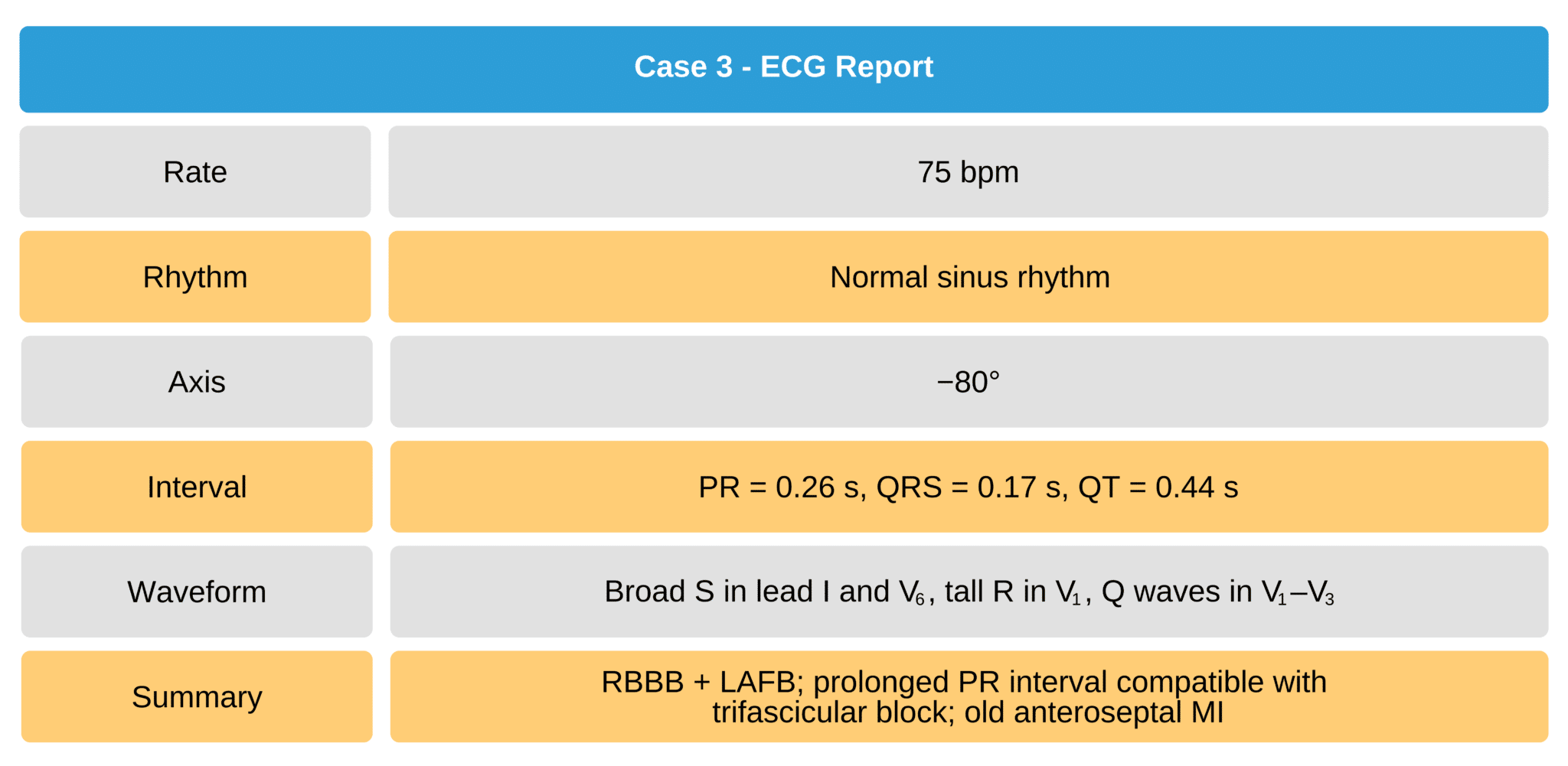 Topic - Trifascicular Block (RBBB + LAFB + LPFB) | 12-Lead ECG ...