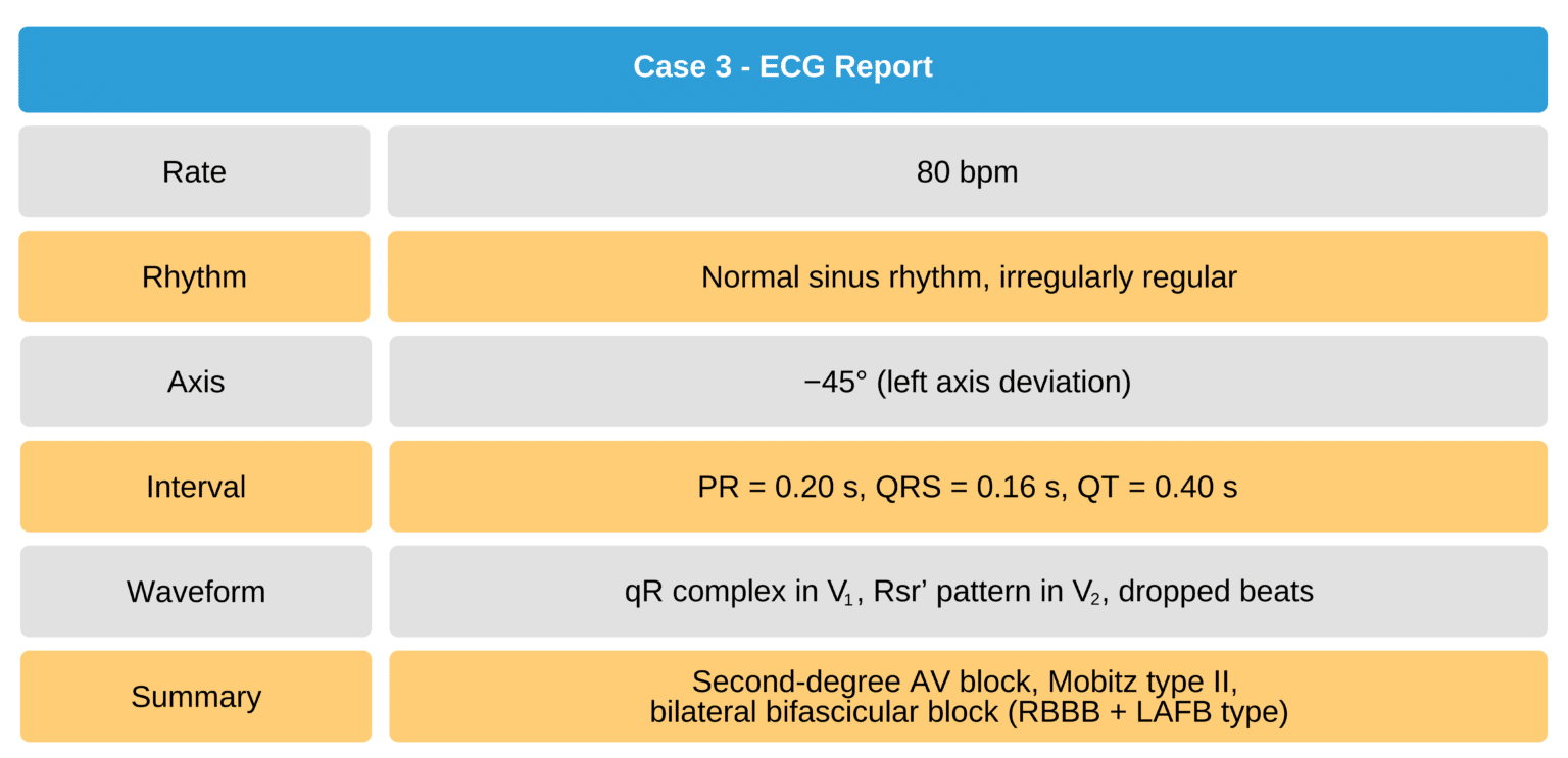 Topic - Second-Degree Atrioventricular Block, Mobitz Type II | 12-Lead ...