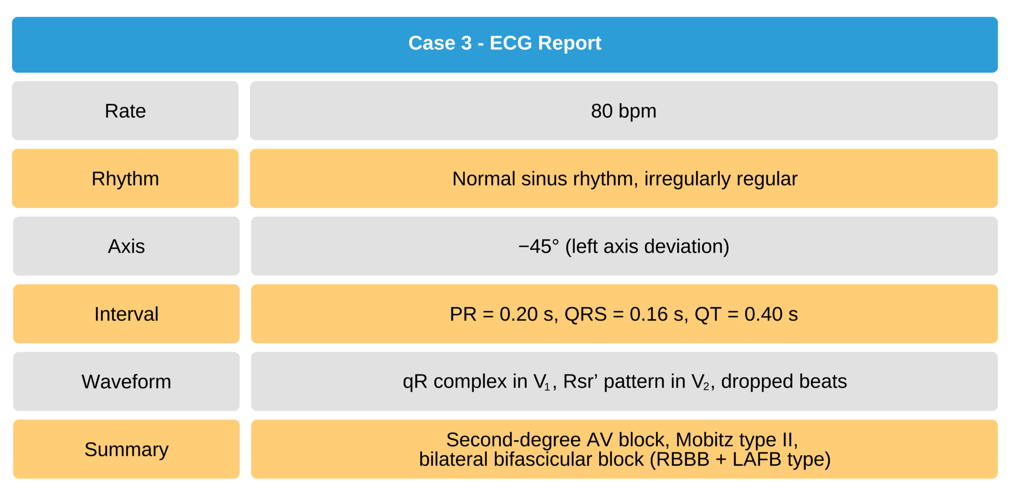 Topic - Second-Degree Atrioventricular Block, Mobitz Type II | 12-Lead ...
