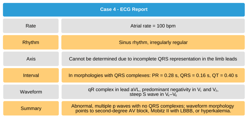 Topic - Second-Degree Atrioventricular Block, Mobitz Type II | 12-Lead ...