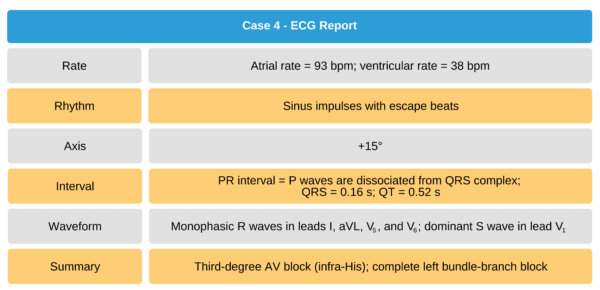 Topic - Third-Degree AV Block, Complete AV Block | 12-Lead ECG ...