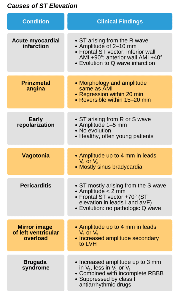 Topic - Changes in the ST Segment | 12 Lead ECG Course | ACLS ...