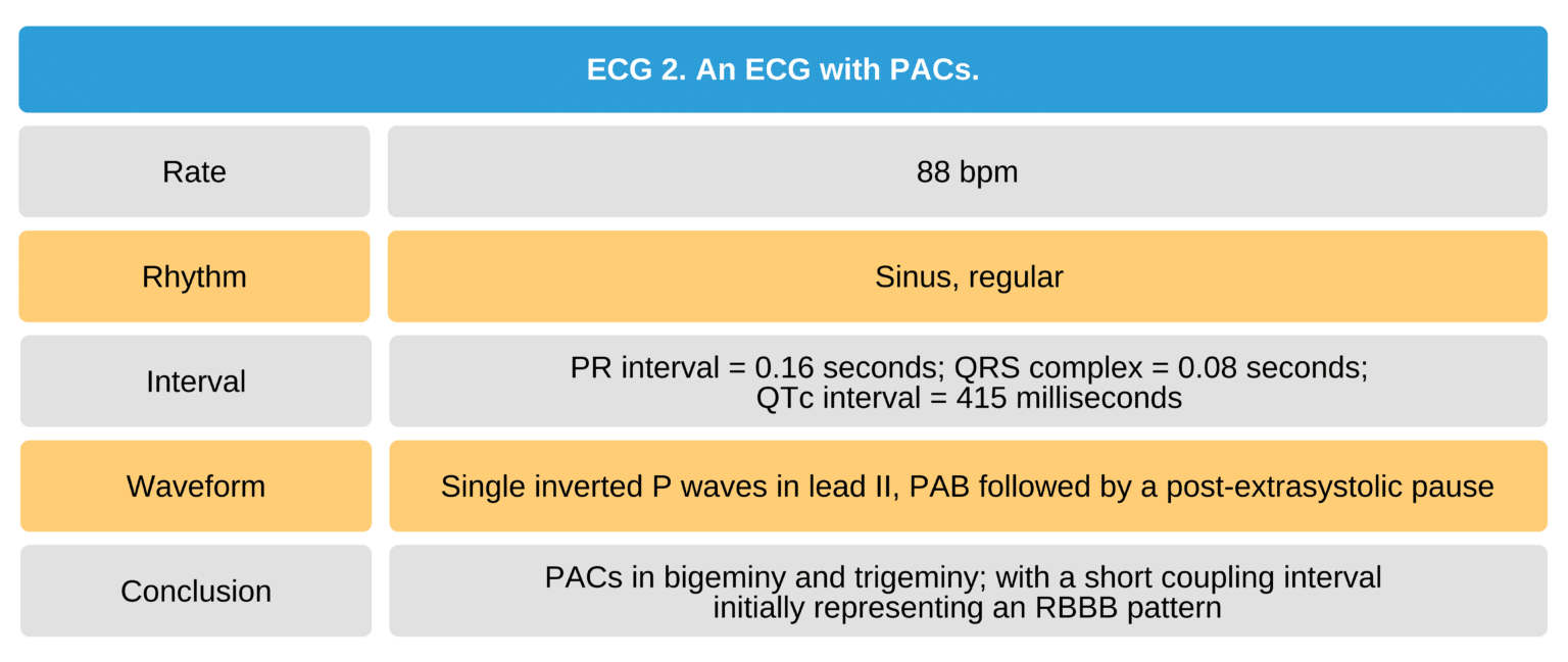 Topic - Premature Atrial Contractions in the Inferior Aspect of the ...