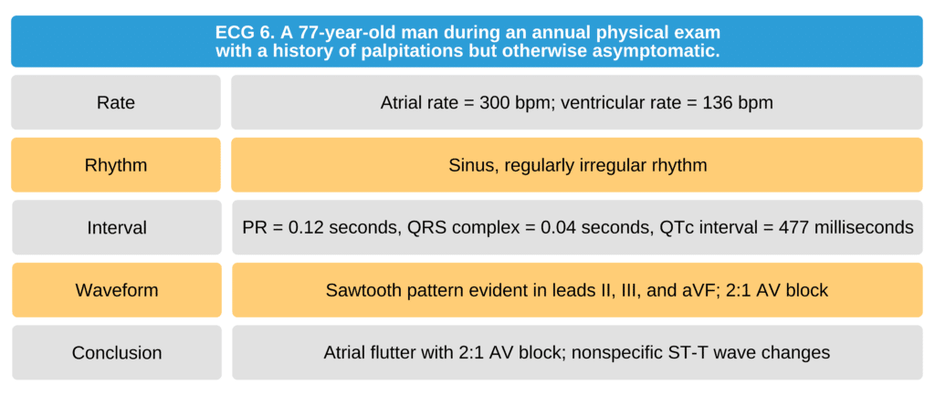 Topic - Atrial Flutter | 12 Lead ECG Course | ACLS Certification ...