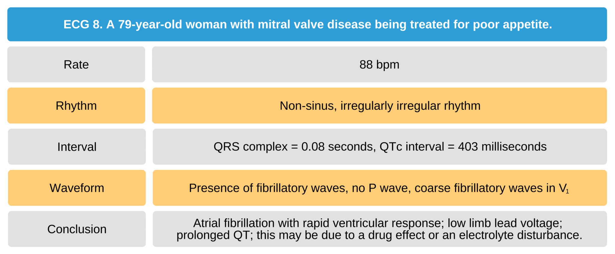 Topic - Atrial Fibrillation | 12 Lead ECG Course | ACLS Certification ...