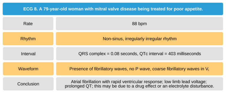 Topic - Atrial Fibrillation | 12 Lead ECG Course | ACLS Certification Association