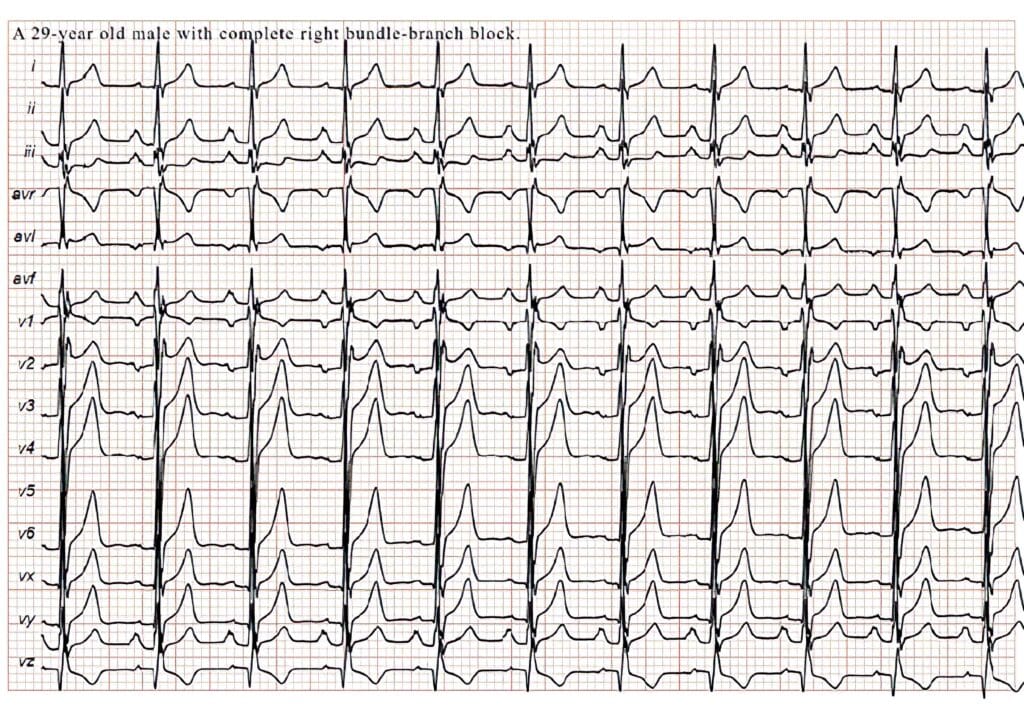Topic - Complete Right Bundle-Branch Block | 12-Lead ECG Certification ...